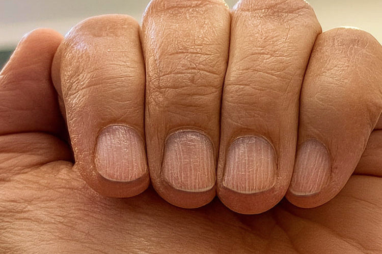Tired of nail ridges that make your hands appear older? This dermatolo ...